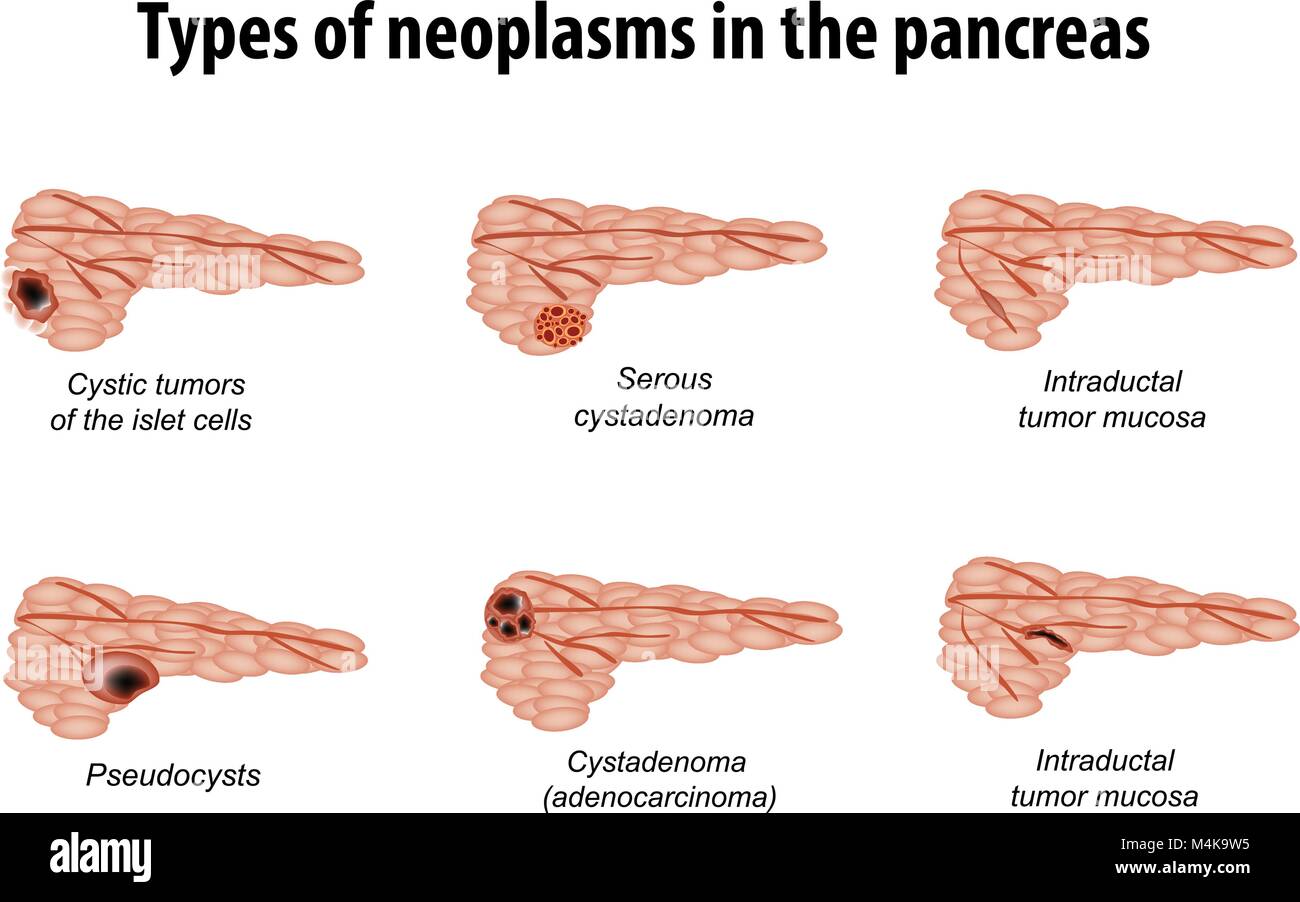 Types of neoplasms in the pancreas. Infographics. Set. Vector ...