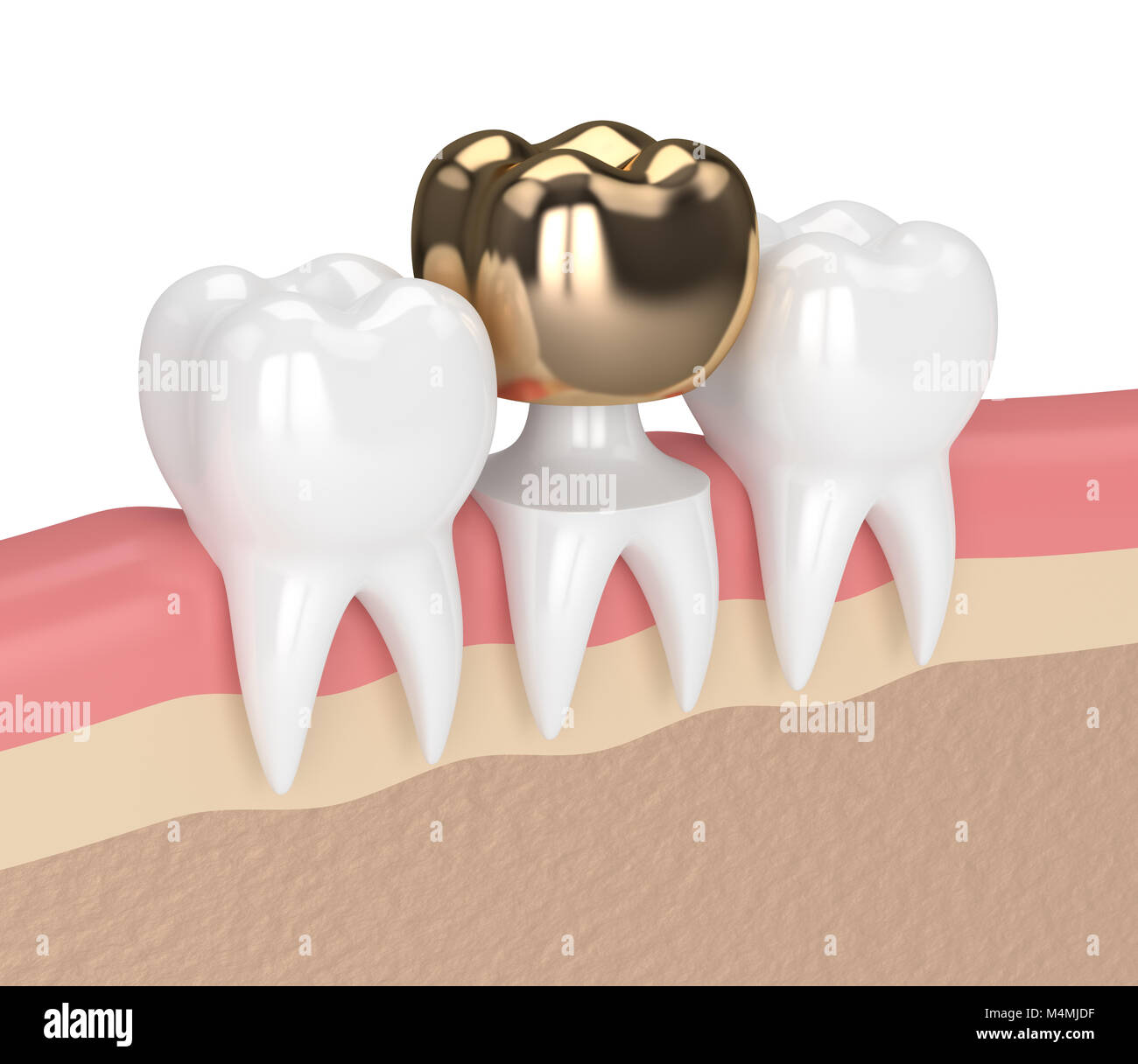 Root Canal Gold Crown