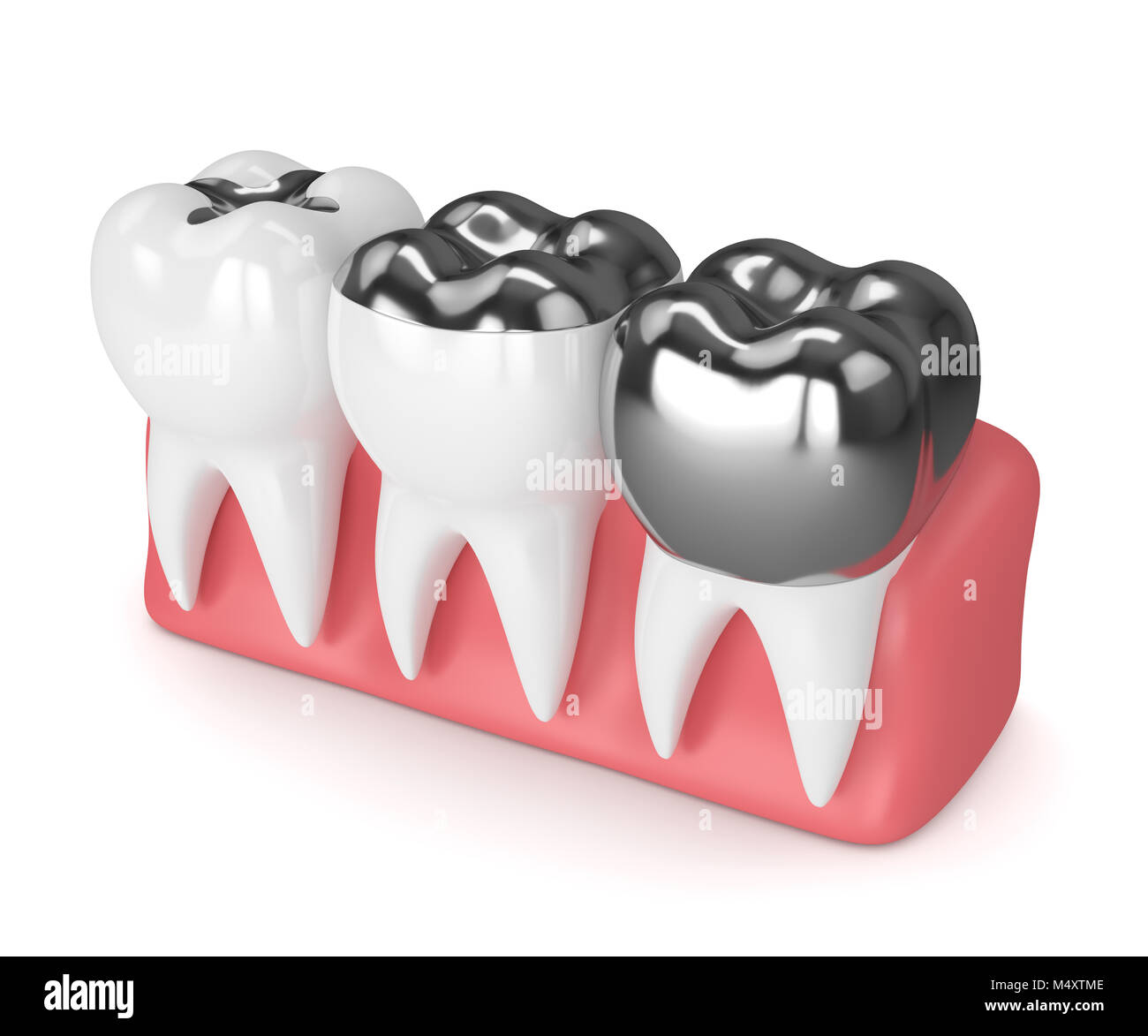 3d render of teeth with inlay, onlay and crown amalgam filling over ...