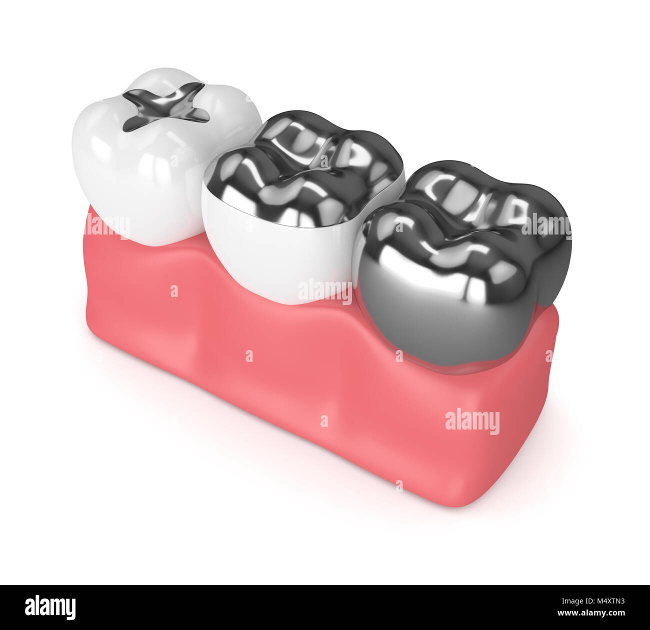 3d render of teeth with inlay, onlay and crown amalgam filling over ...