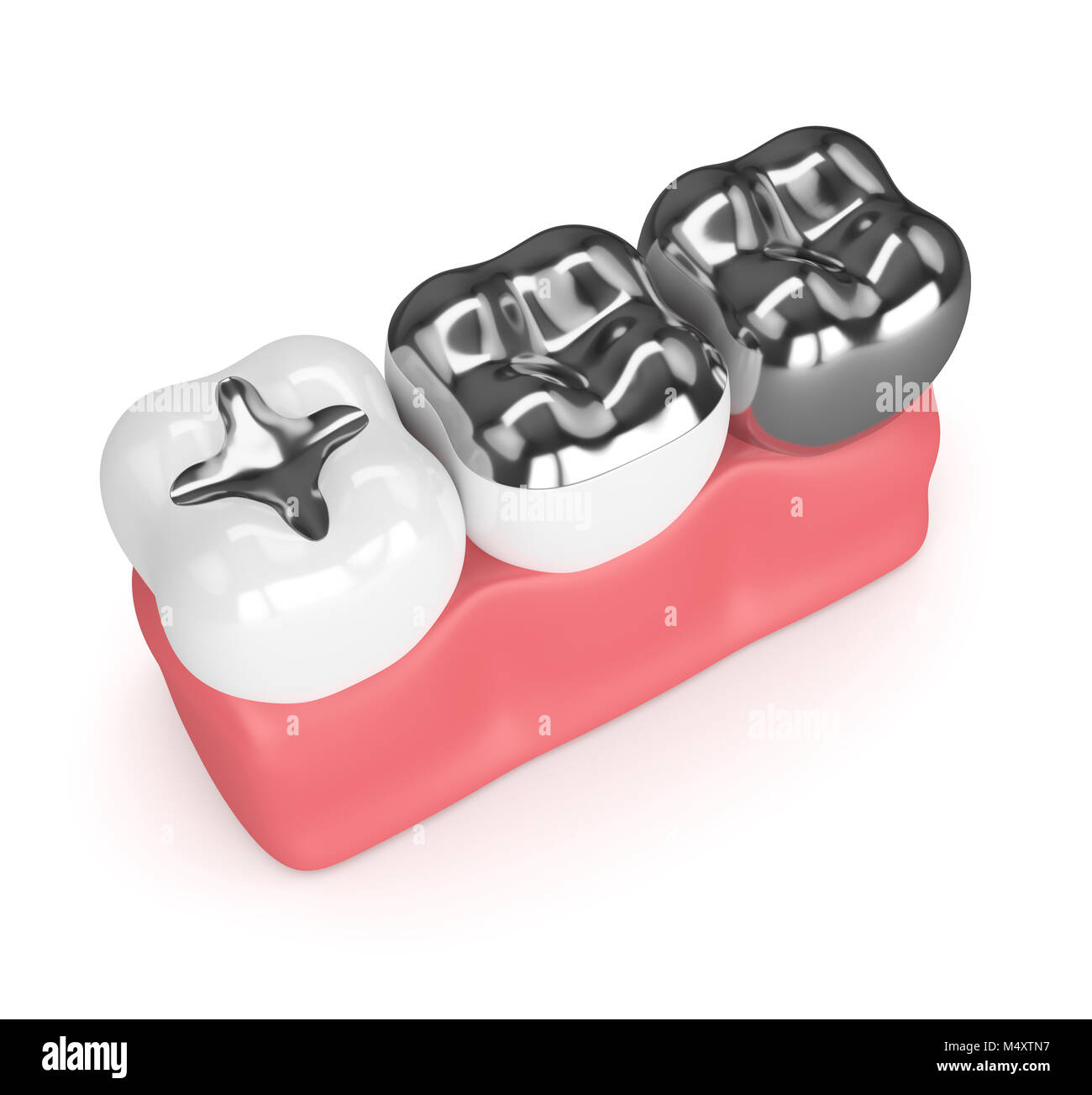 3d render of teeth with inlay, onlay and crown amalgam filling over ...