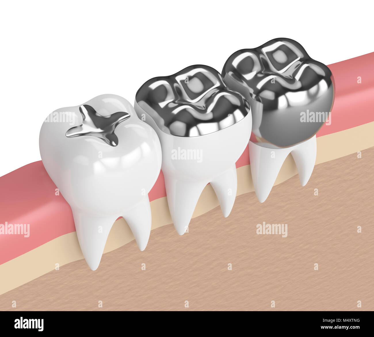 3d render of teeth with inlay, onlay and crown amalgam filling over ...