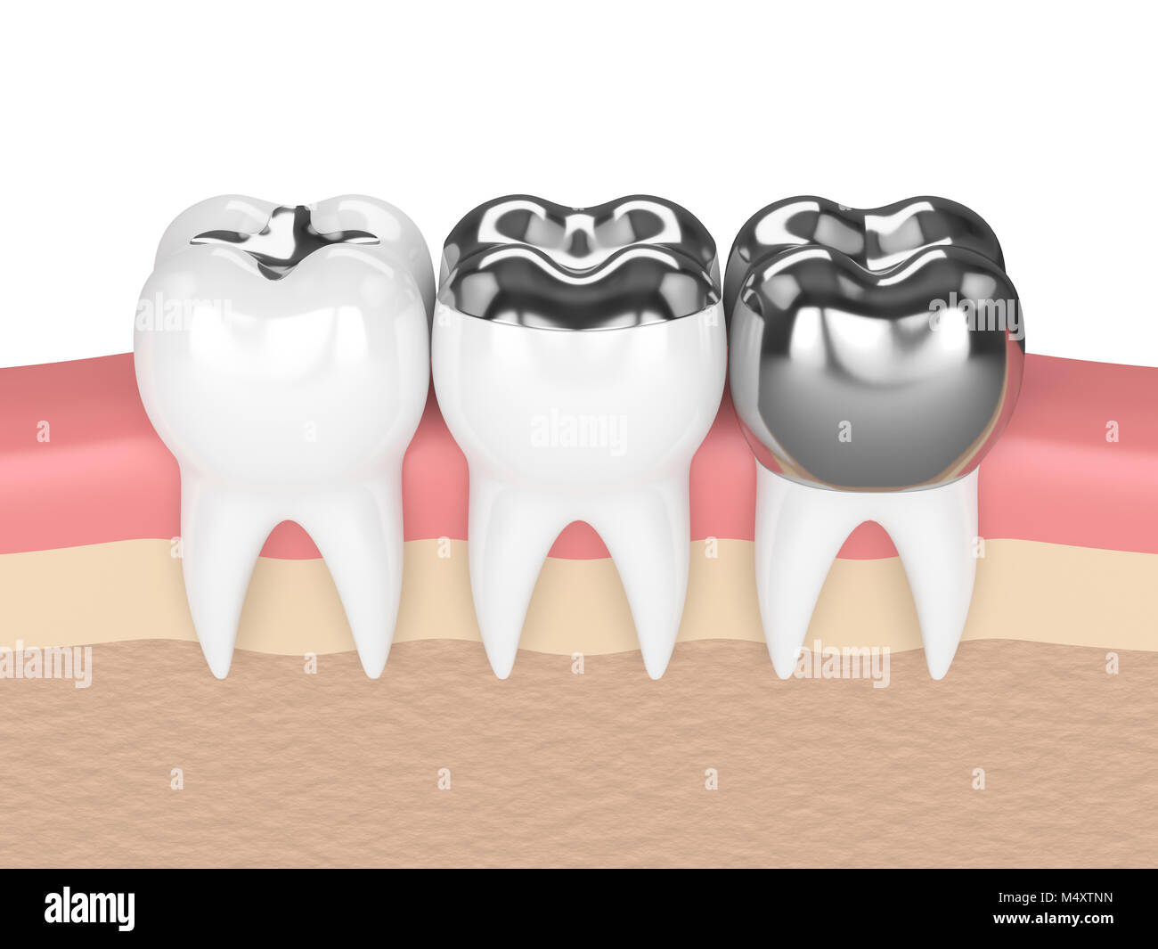 3d render of teeth with inlay, onlay and crown amalgam filling in gums ...