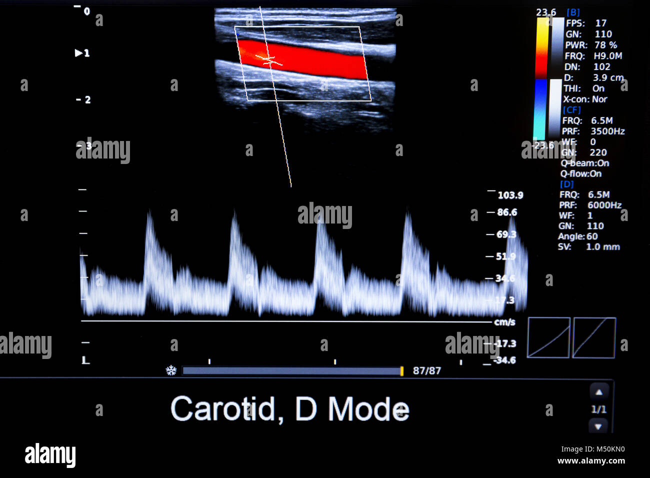 Echocardiography monitor hi-res stock photography and images - Alamy