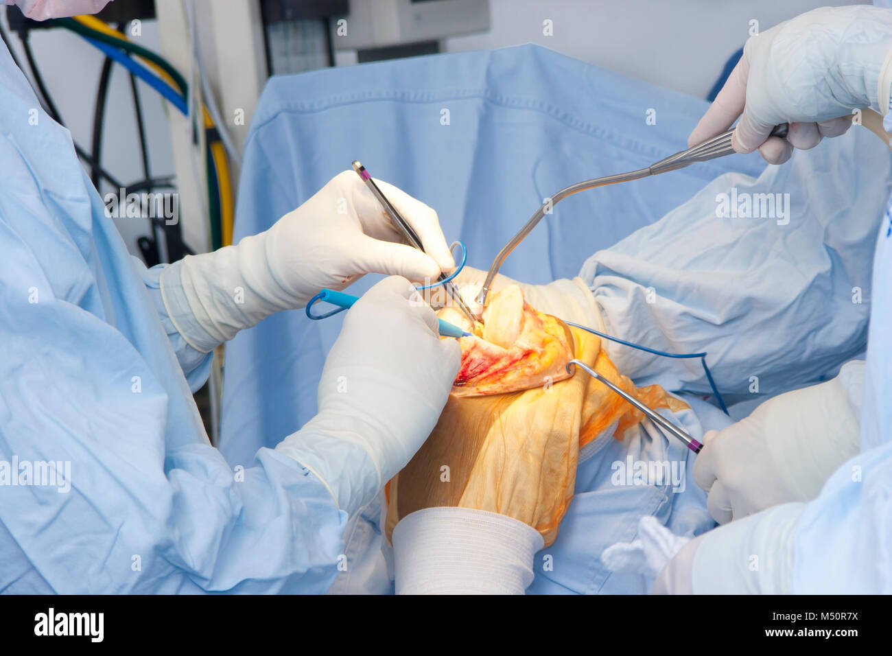 Detail of Surgery, Orthopedic Operation, Knee Surgery Stock Photo - Alamy