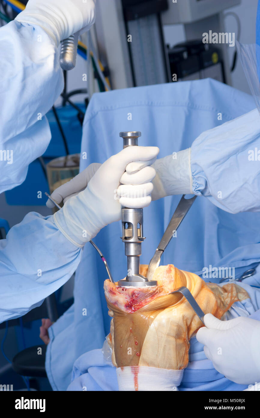 Knee operation hi-res stock photography and images - Alamy