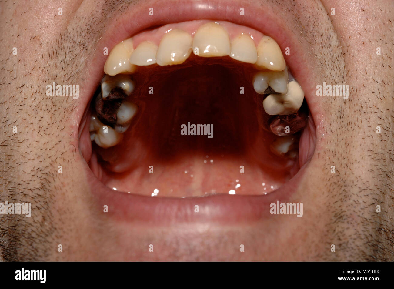 teeth of European man in his 30s Stock Photo - Alamy