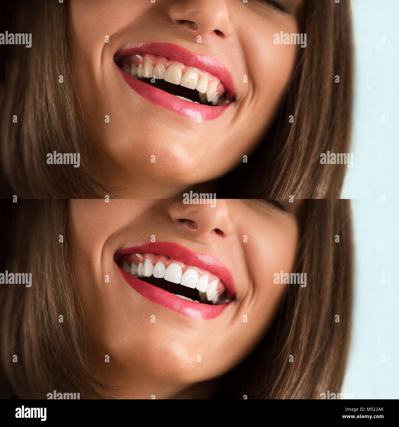 Whitening - bleaching treatment, before and after, woman teeth and ...