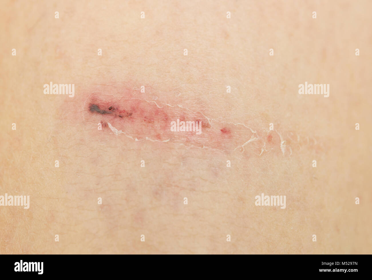 Bruised skin hi-res stock photography and images - Alamy