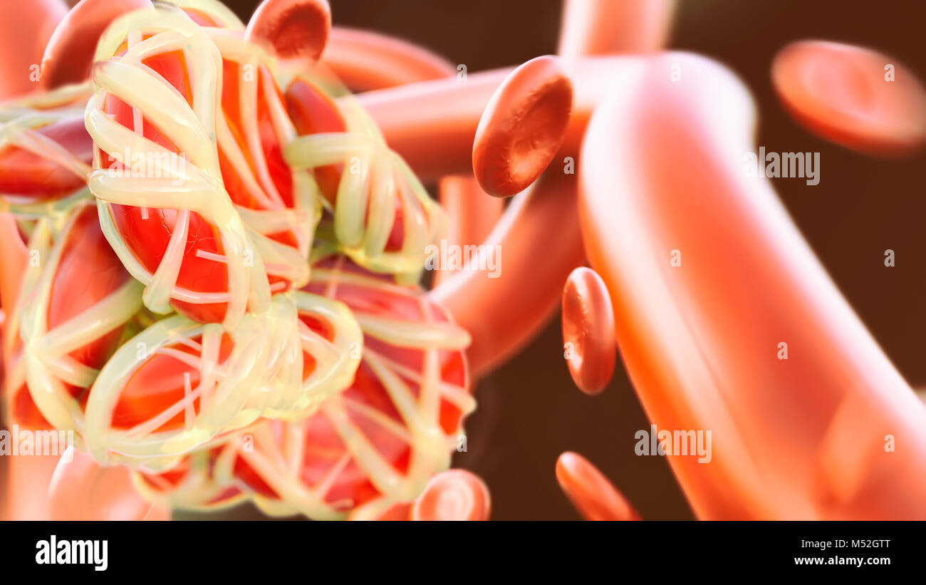 Closeup Thrombose- 3D rendering Stock Photo - Alamy