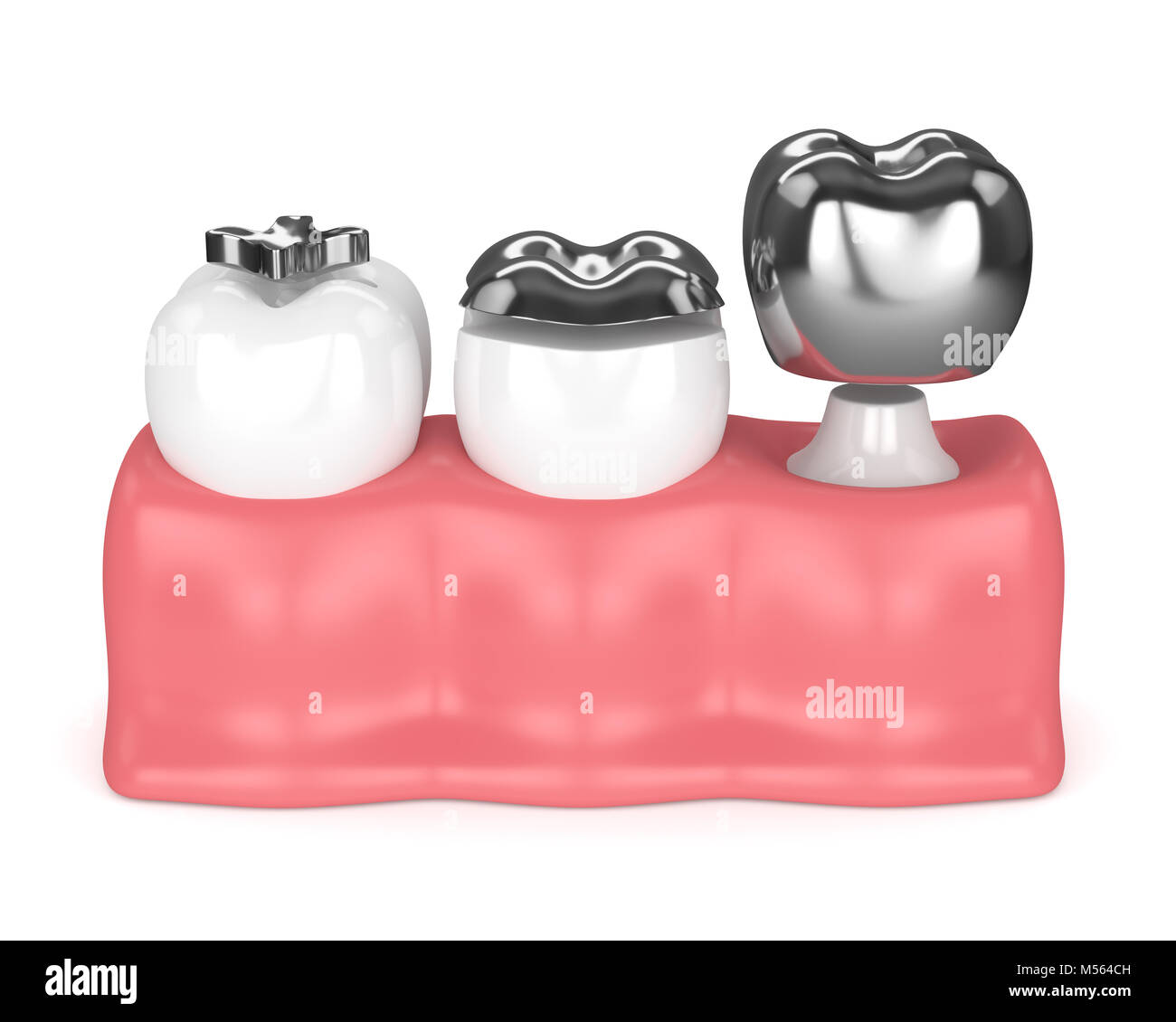 3d render of teeth with inlay, onlay and crown amalgam filling in gums ...