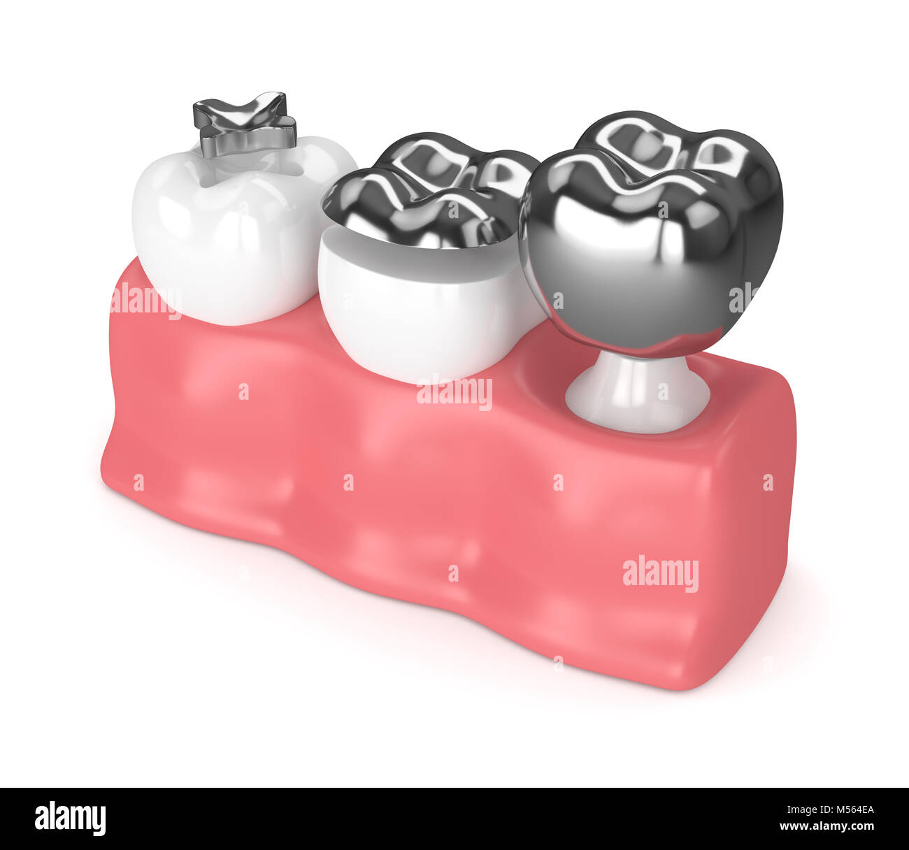 3d render of teeth with inlay, onlay and crown amalgam filling in gums ...