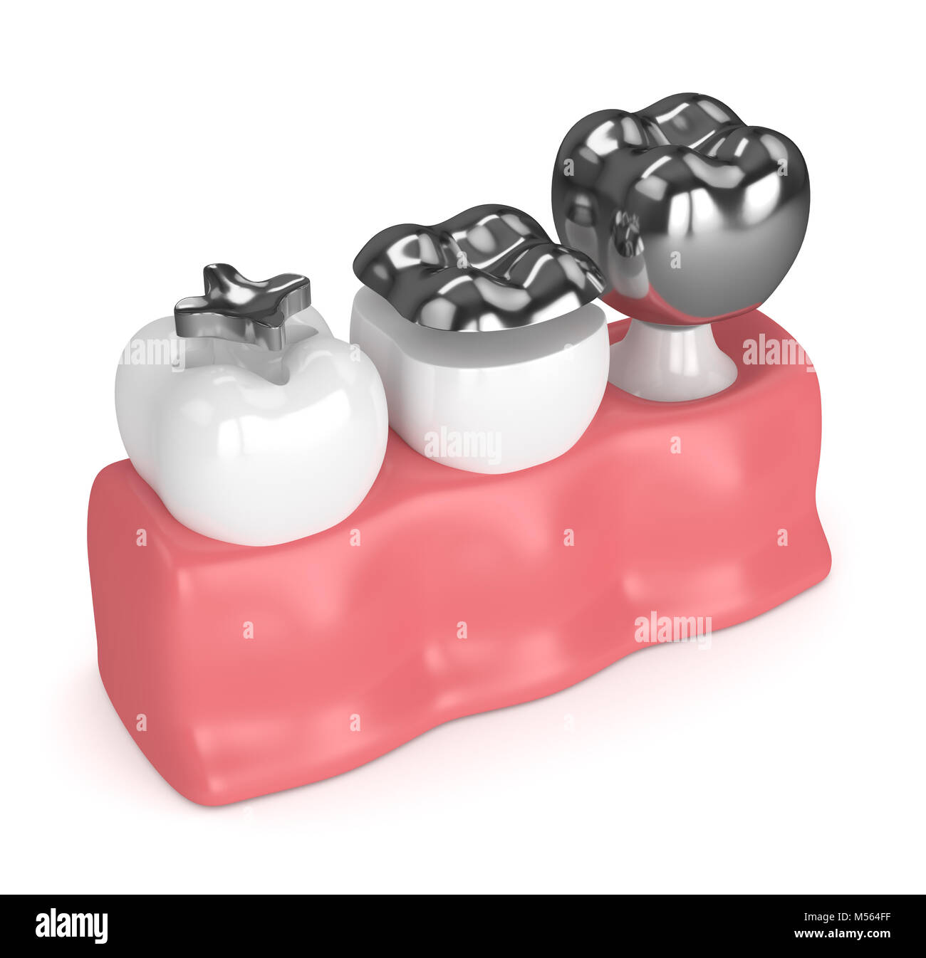 3d render of teeth with inlay, onlay and crown amalgam filling in gums ...