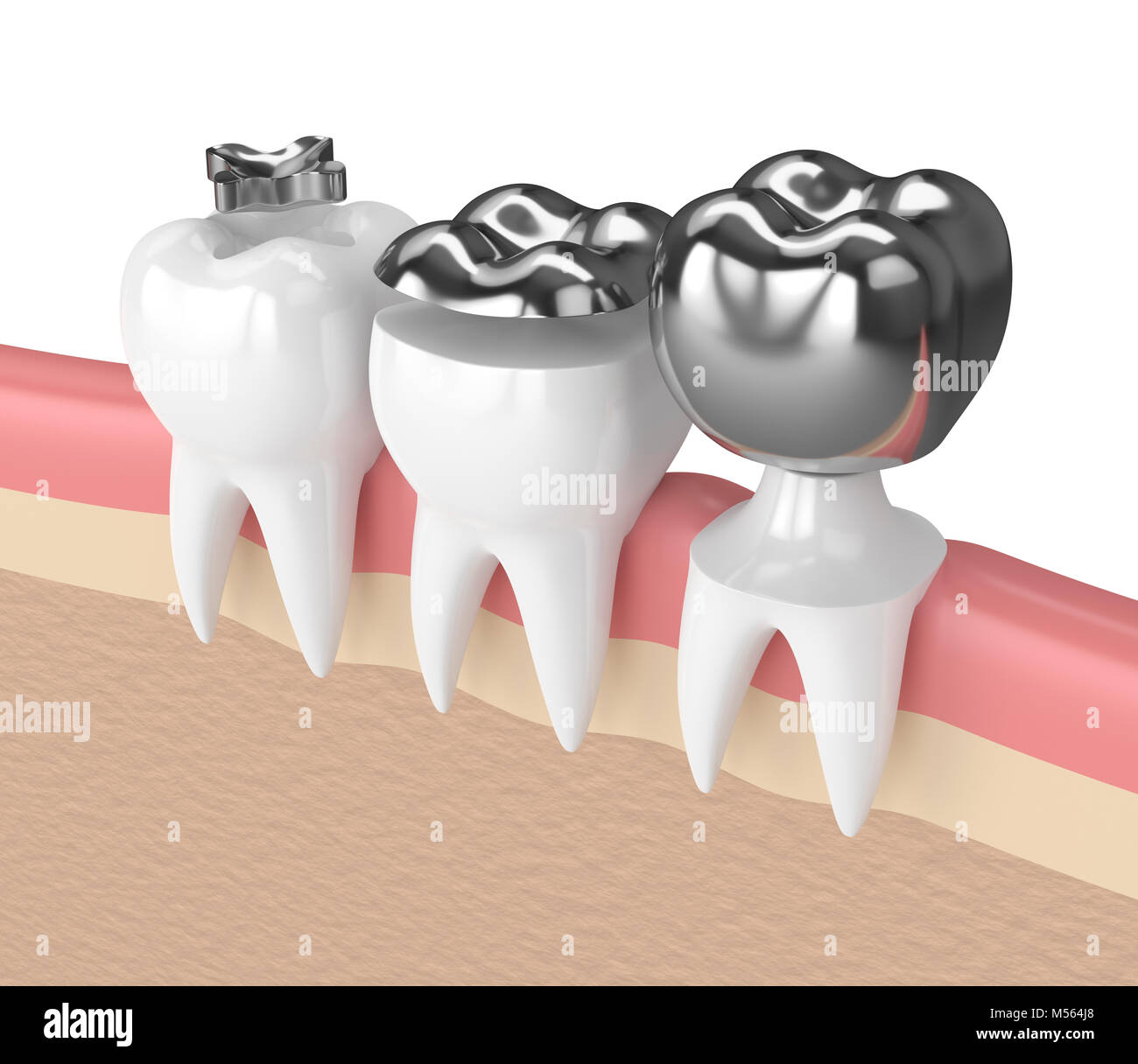 3d render of teeth with inlay, onlay and crown amalgam filling in gums ...