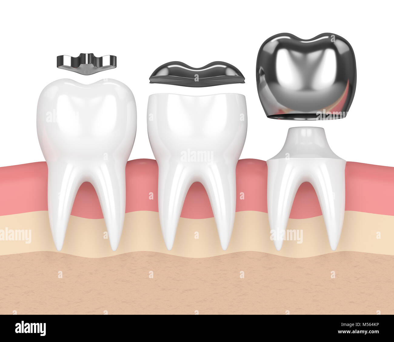3d render of teeth with inlay, onlay and crown amalgam filling in gums ...