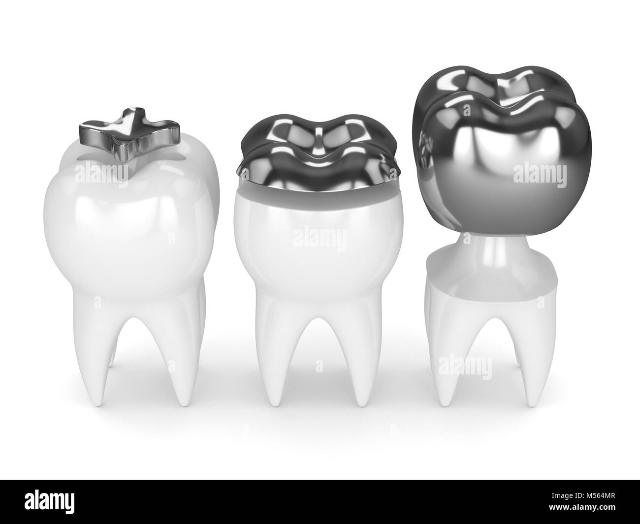 3d render of teeth with inlay, onlay and crown amalgam filling over ...