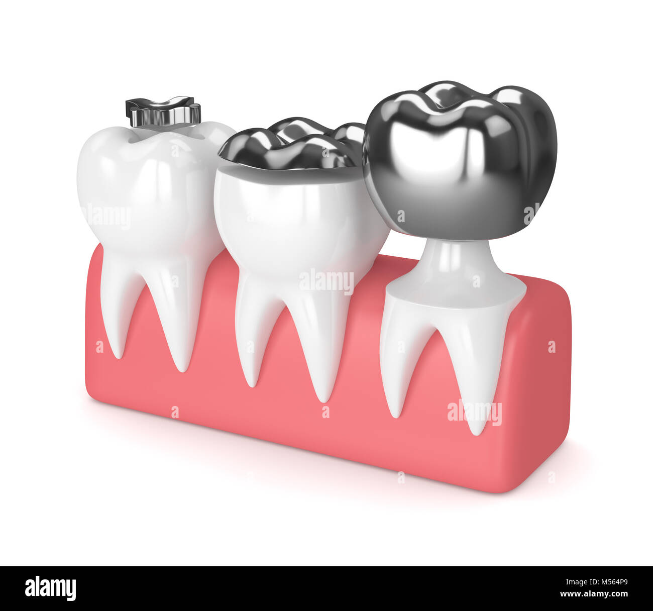 3d render of teeth with inlay, onlay and crown amalgam filling over ...