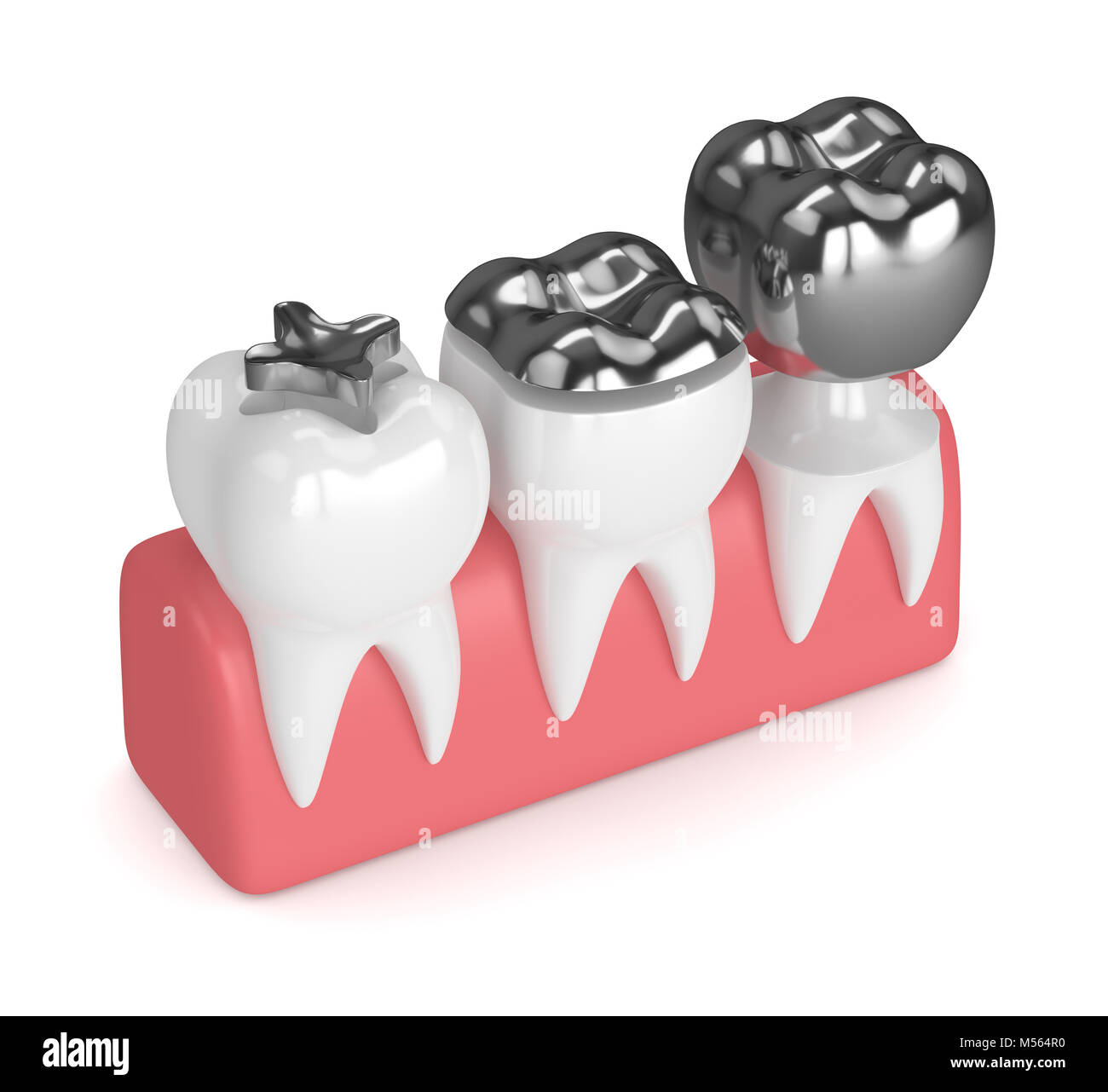 3d render of teeth with inlay, onlay and crown amalgam filling over ...