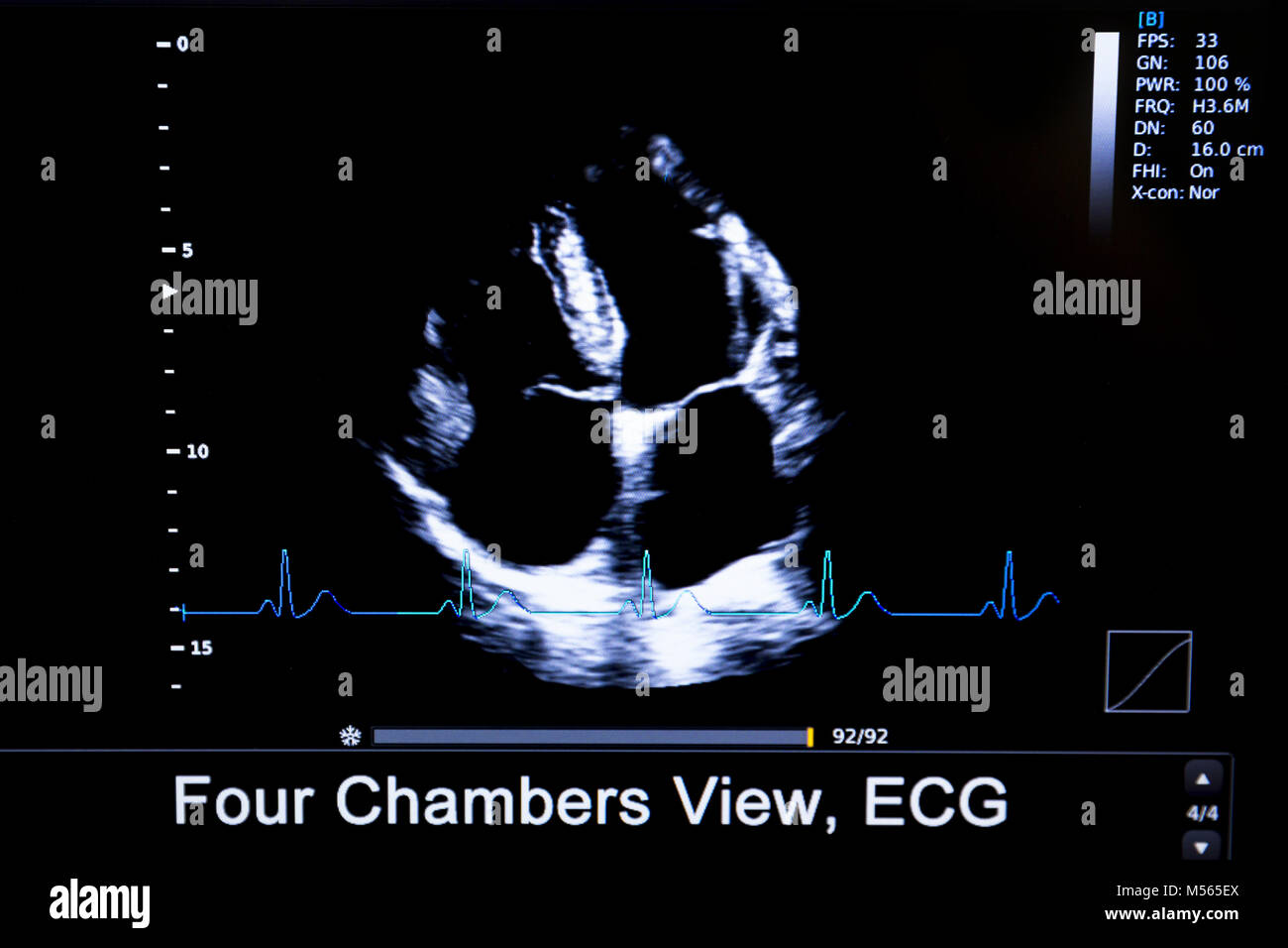 Echocardiography monitor hi-res stock photography and images - Alamy