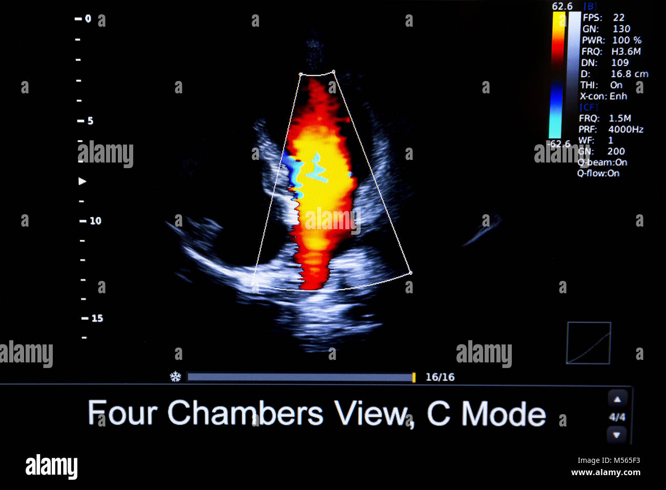 Ultrasound heart chambers hi-res stock photography and images - Alamy