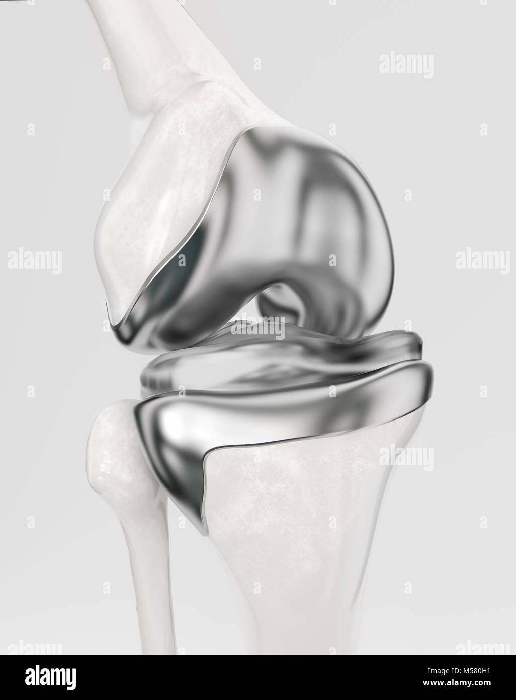 Knee with modern knee prosthesis - 3D Rendering Stock Photo - Alamy
