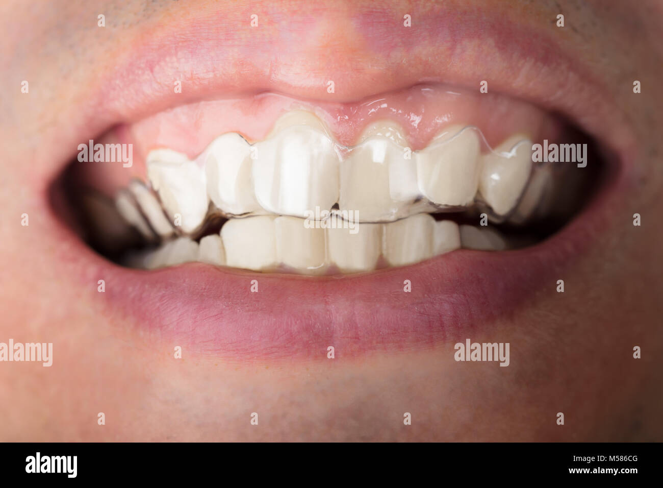 Skin of the teeth hi-res stock photography and images - Alamy