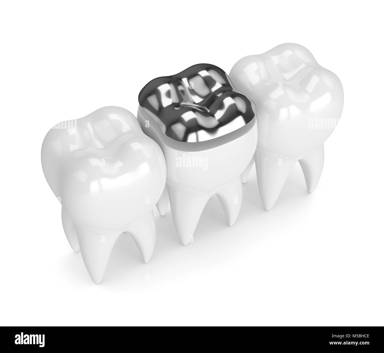 3d render of teeth with dental onlay amalgam filling over white ...
