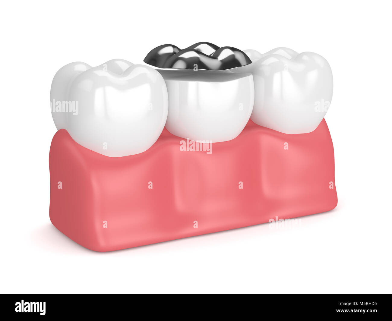 3d render of teeth with dental onlay amalgam filling in gums over white ...