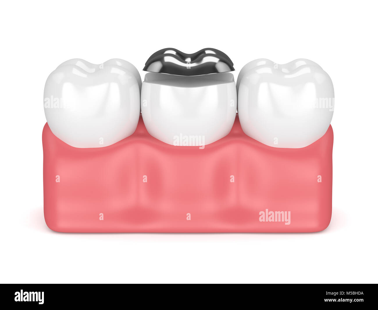 3d render of teeth with dental onlay amalgam filling in gums over white ...