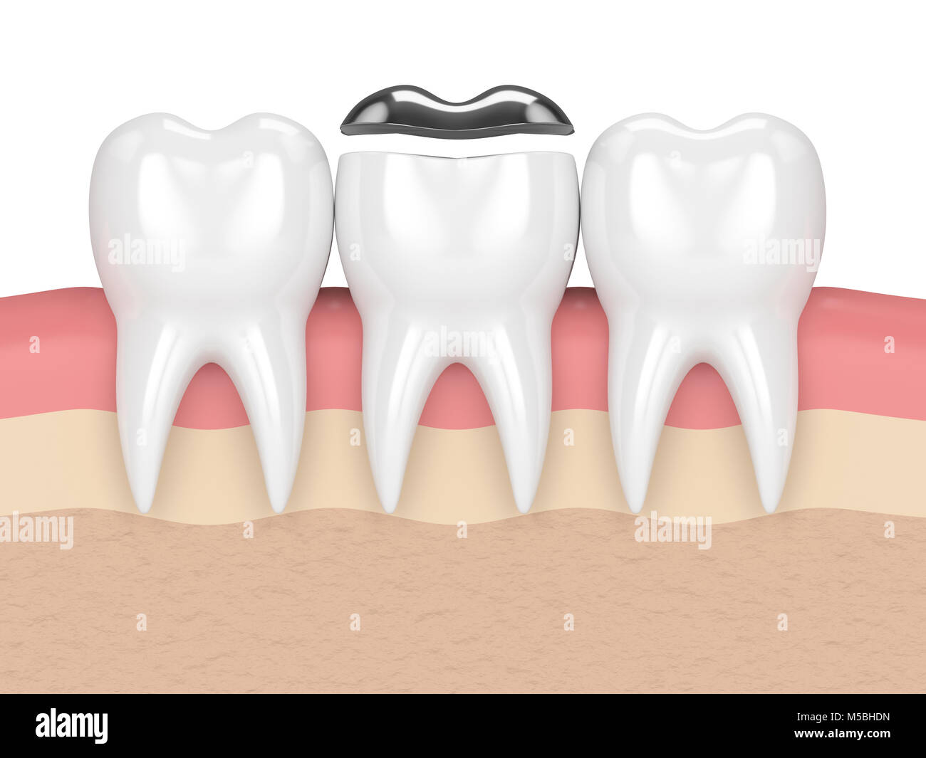3d render of teeth with dental onlay amalgam filling in gums Stock ...