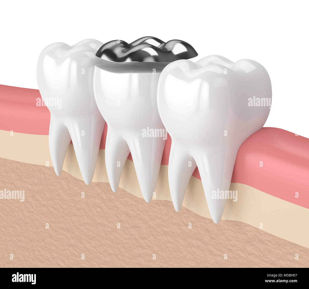 3d render of teeth with dental onlay amalgam filling in gums Stock ...