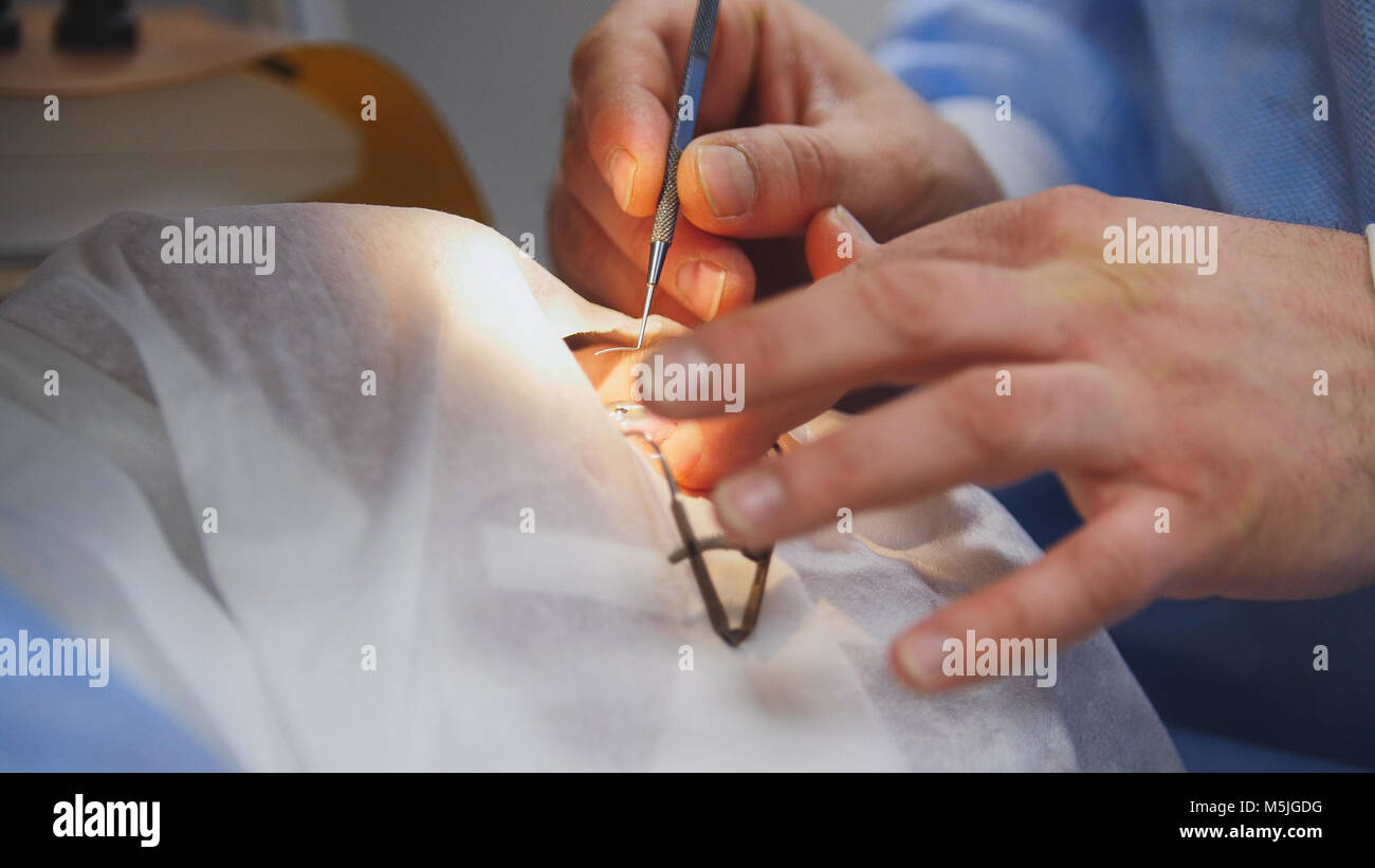 Laser correction for vision - ophthalmology surgery, eyes Stock Photo ...