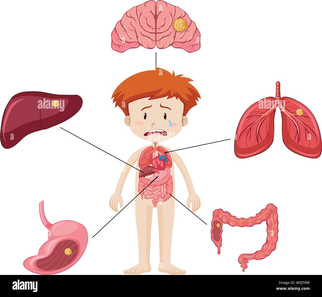 Boy and diagram showing different parts of organs with disease ...