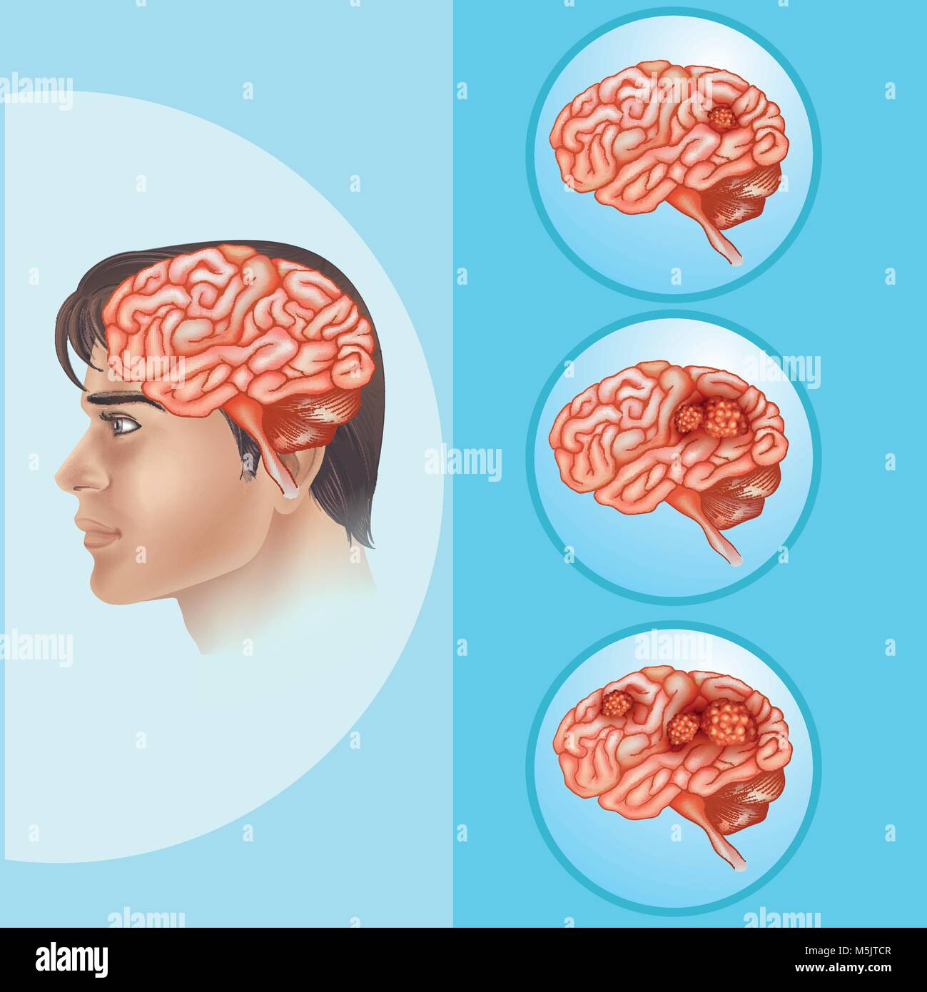 Diagram showing brain cancer in human illustration Stock Vector Image ...