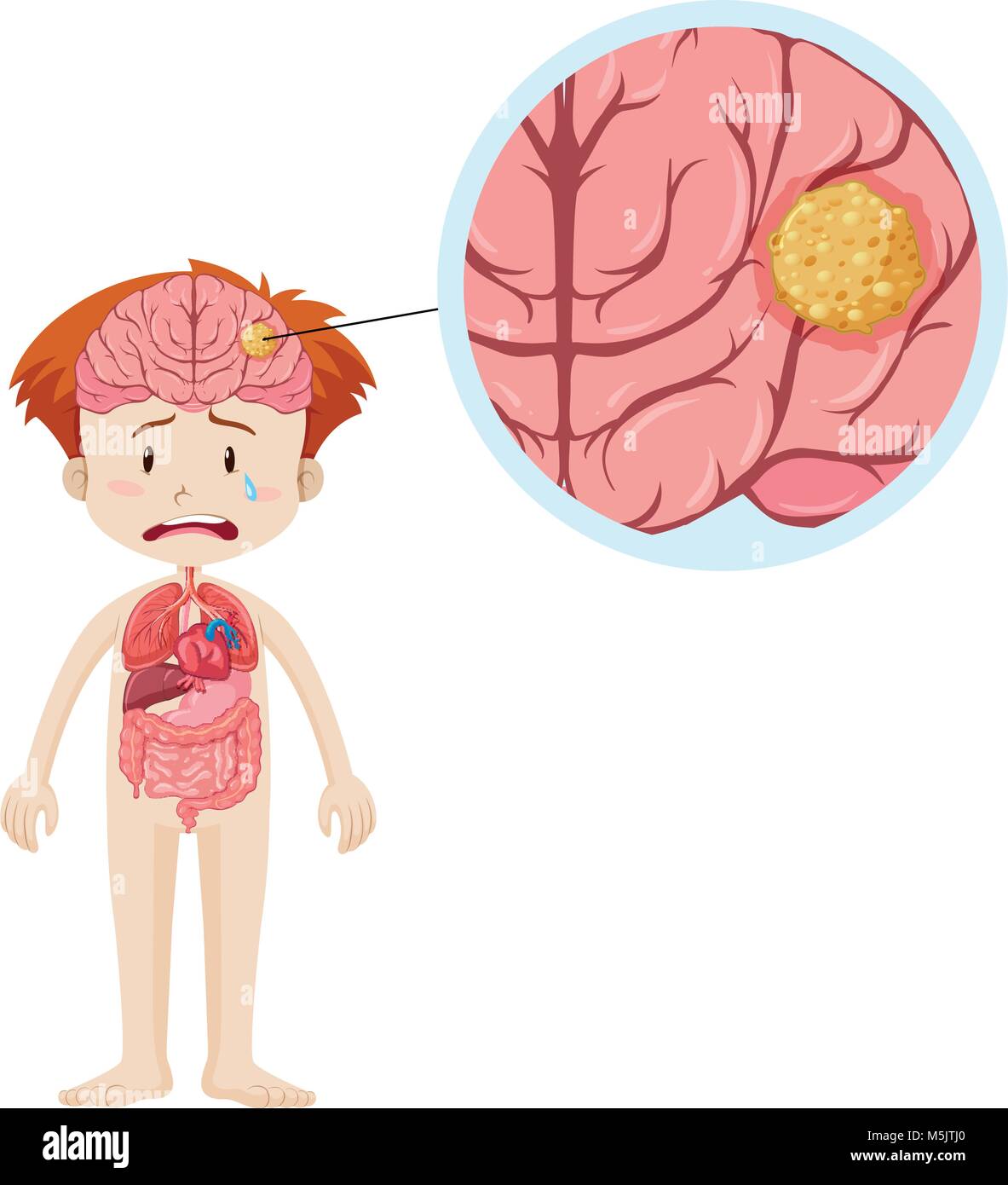 Brain Cancer Stock Photos & Brain Cancer Stock Images - Alamy