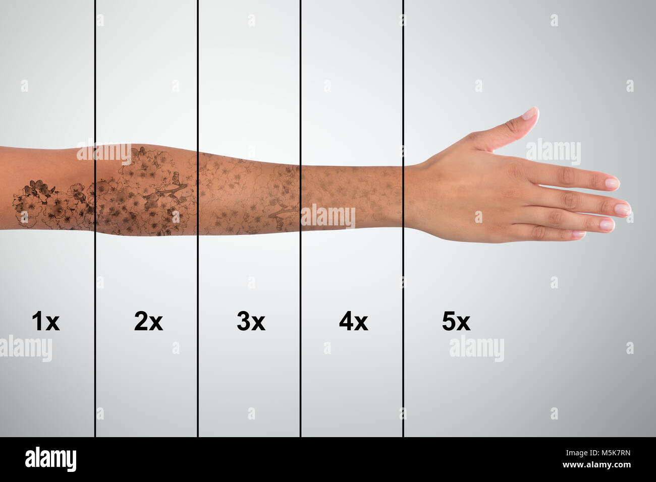 Laser Tattoo Removal On Woman's Hand Against Grey Background Stock ...