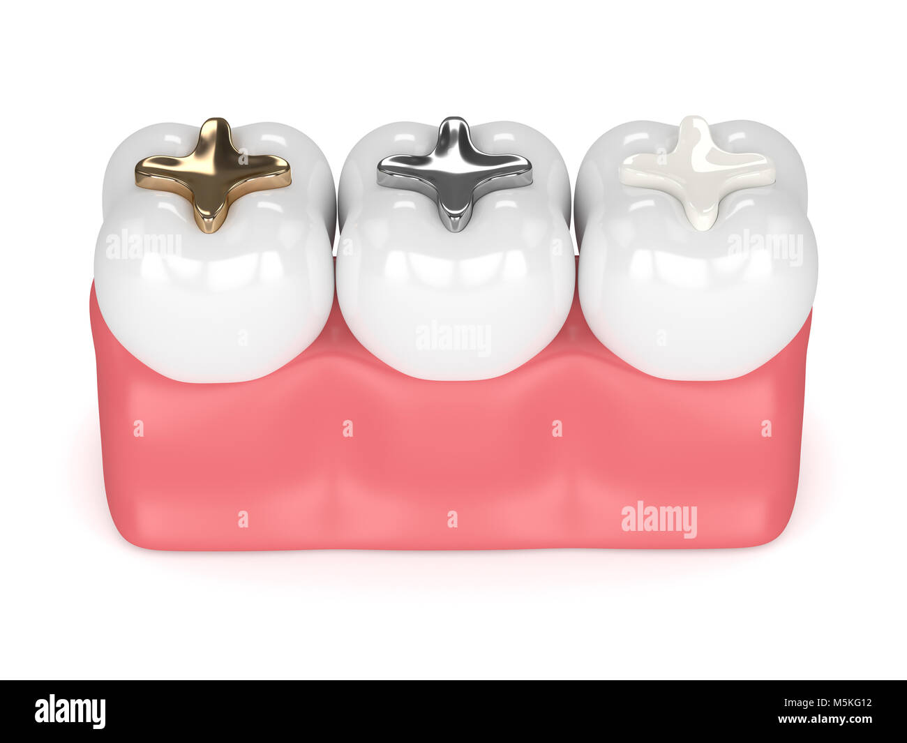 What Is The Composition Of Dental Gold at Walton Edwards blog