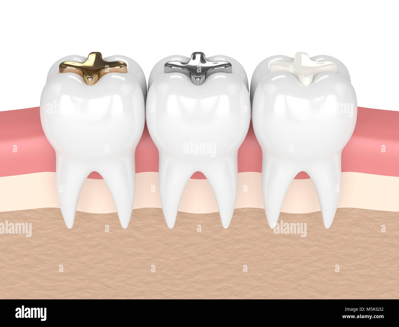 3d render of teeth with gold, amalgam and composite inlay dental ...