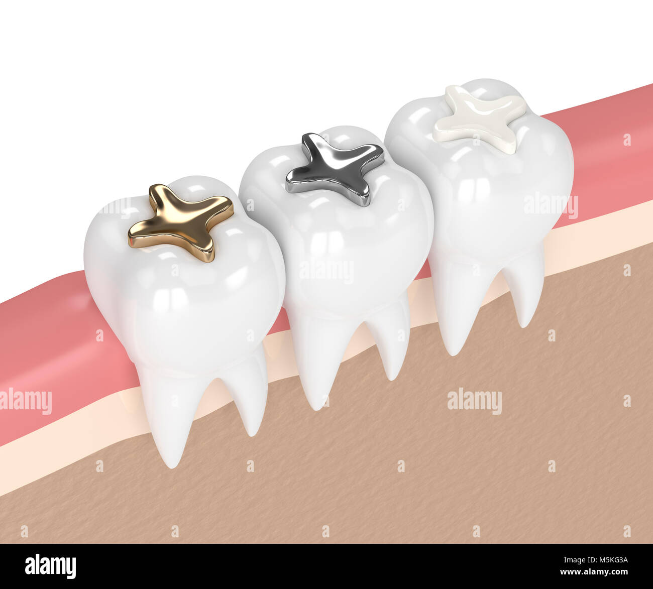3d render of teeth with gold, amalgam and composite inlay dental ...