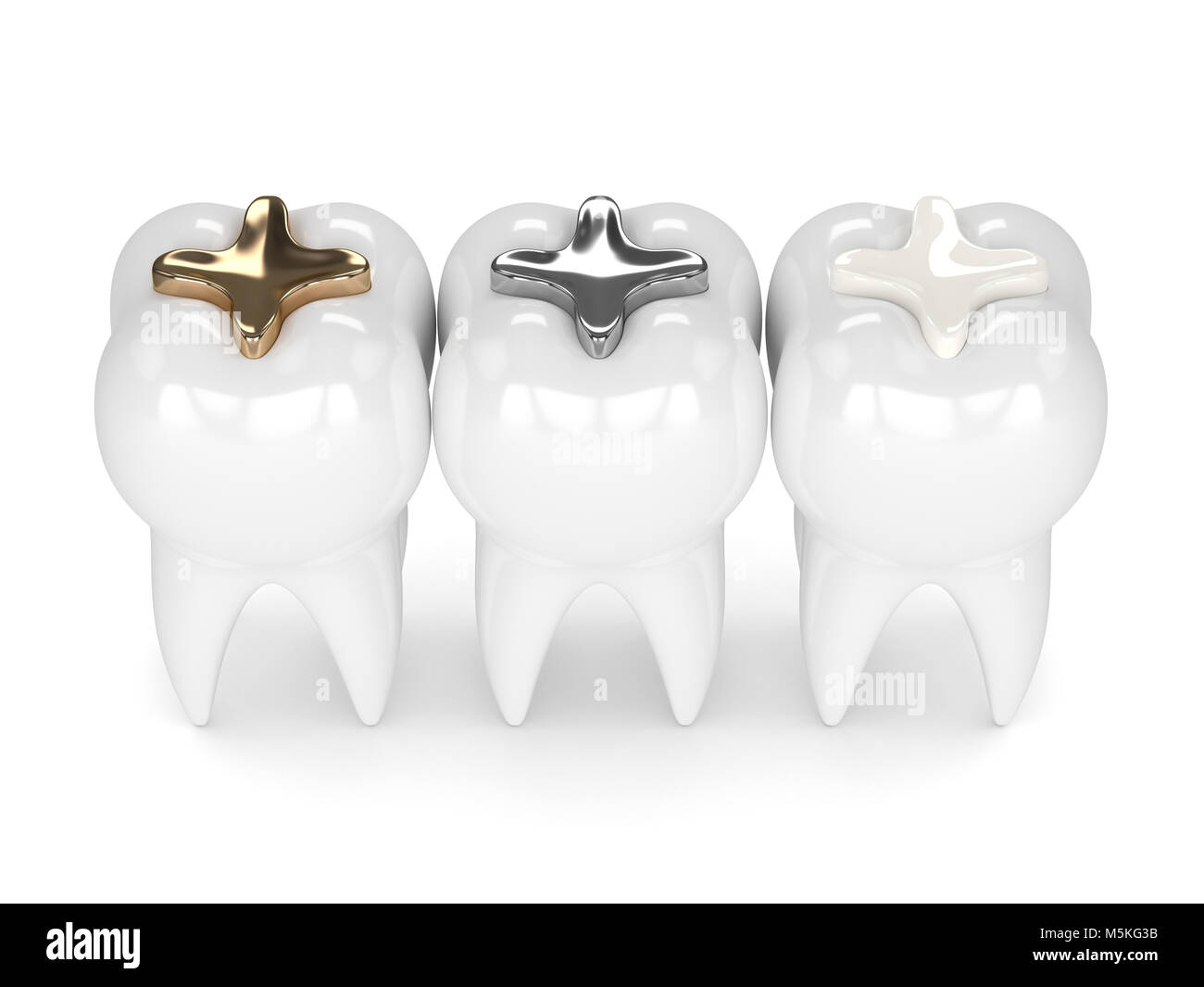 3d render of teeth with gold, amalgam and composite inlay dental ...