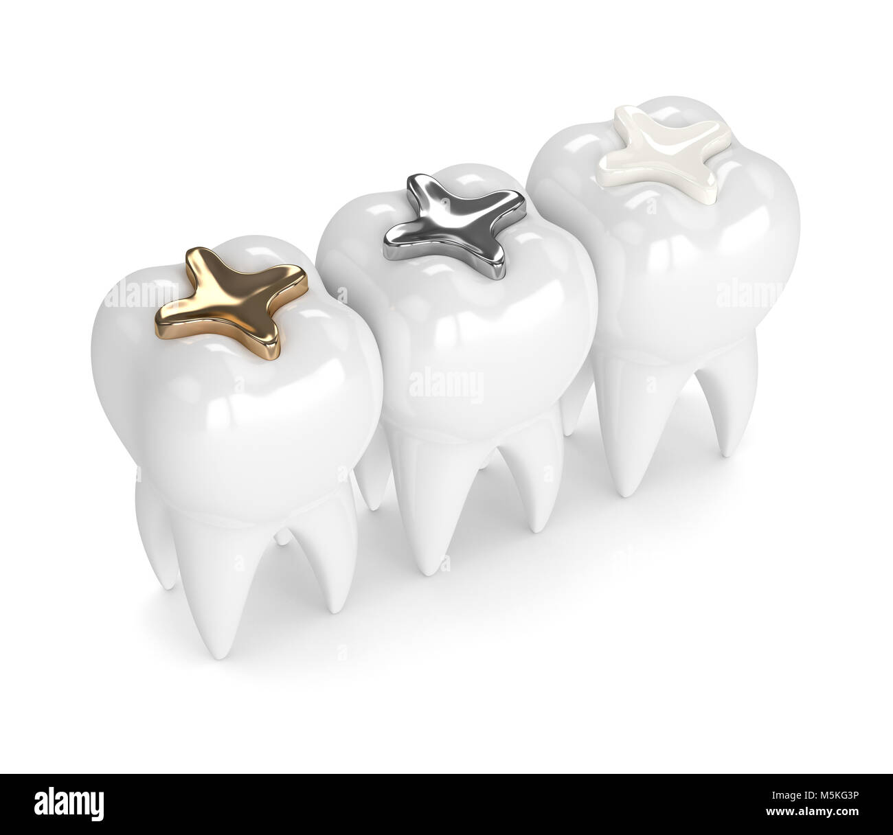 3d render of teeth with gold, amalgam and composite inlay dental ...
