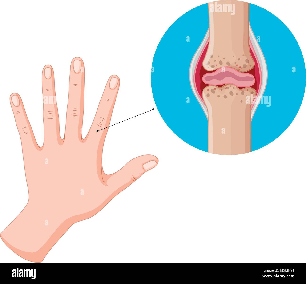 Disease of the joints Cut Out Stock Images & Pictures - Alamy