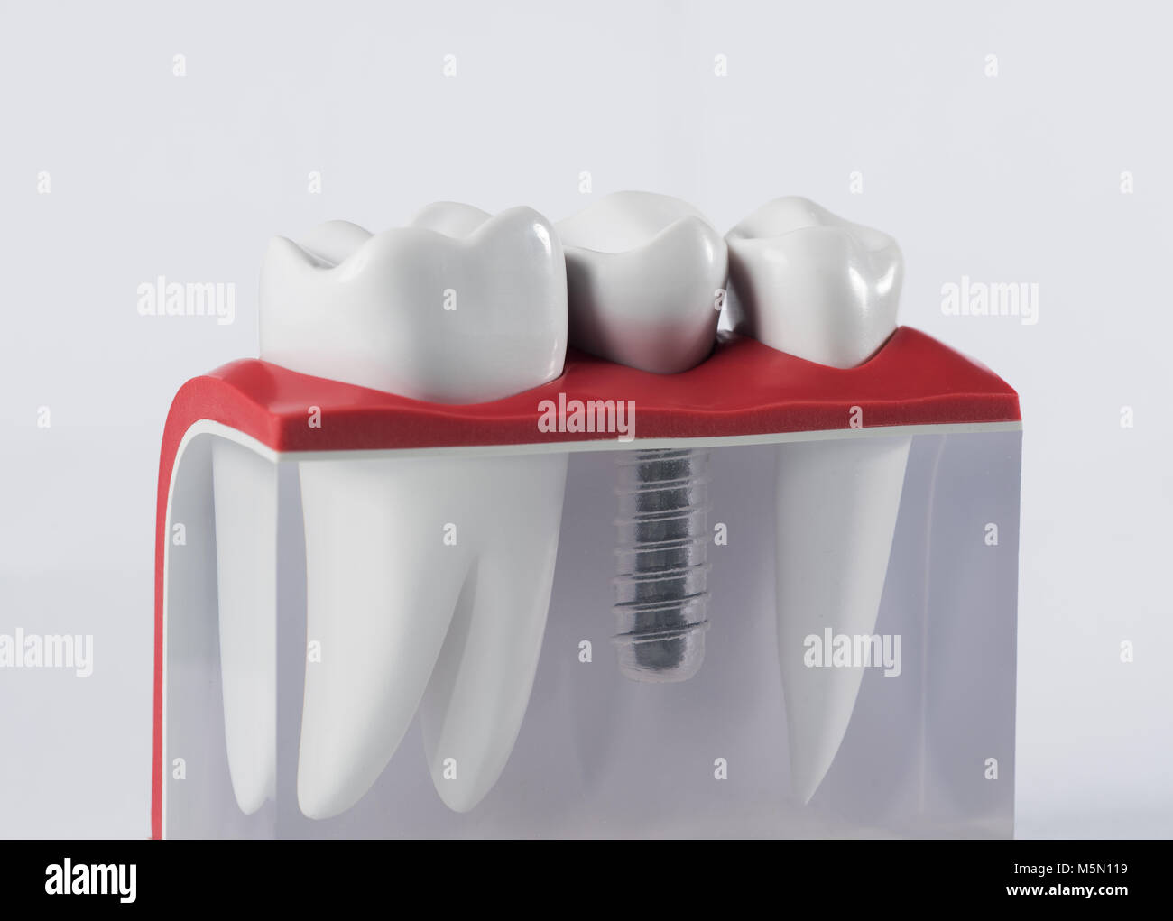 Dental implant tooth hi-res stock photography and images - Alamy
