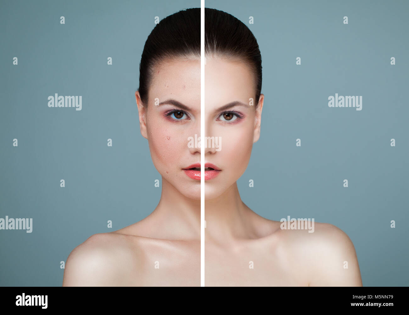 Young Model Woman with Skin Problem and Clear Skin Closeup Portrait ...