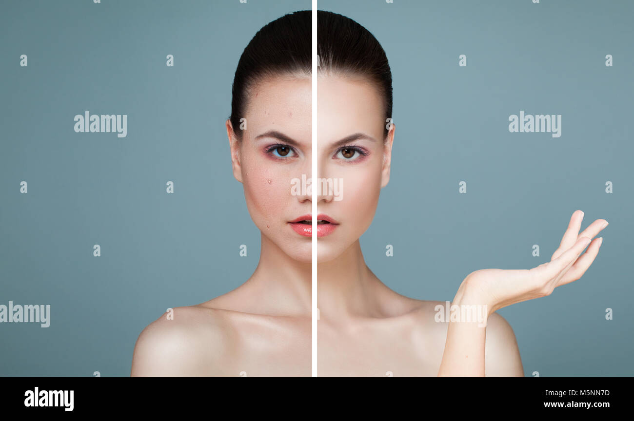 Young Female Face with Skin Problem and Clear Skin. Woman Showing Empty ...