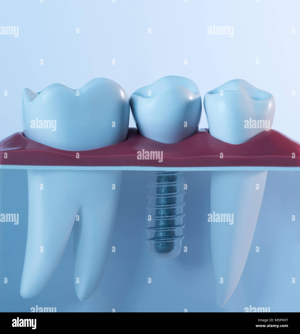 Dental cavity tooth hi-res stock photography and images - Alamy