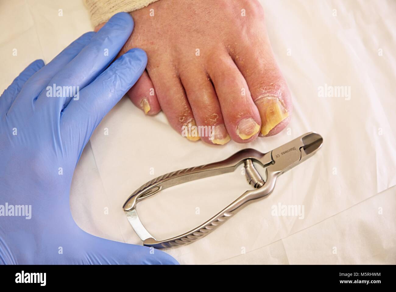Fungus on the toes nails. Twisted toes on the foot with calluses ...