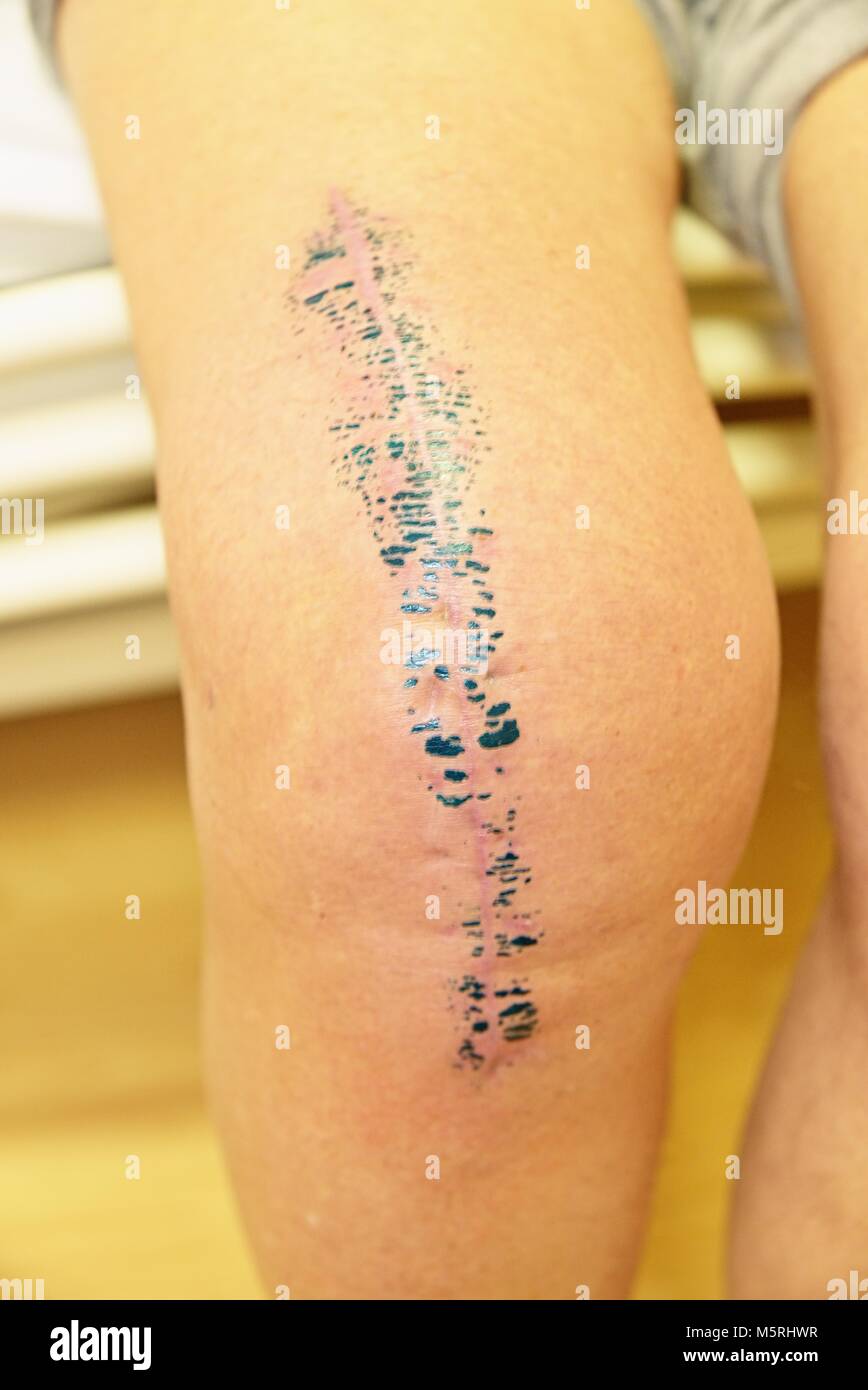 Male knee after surgical operation, knee joint replacement. Knee ...