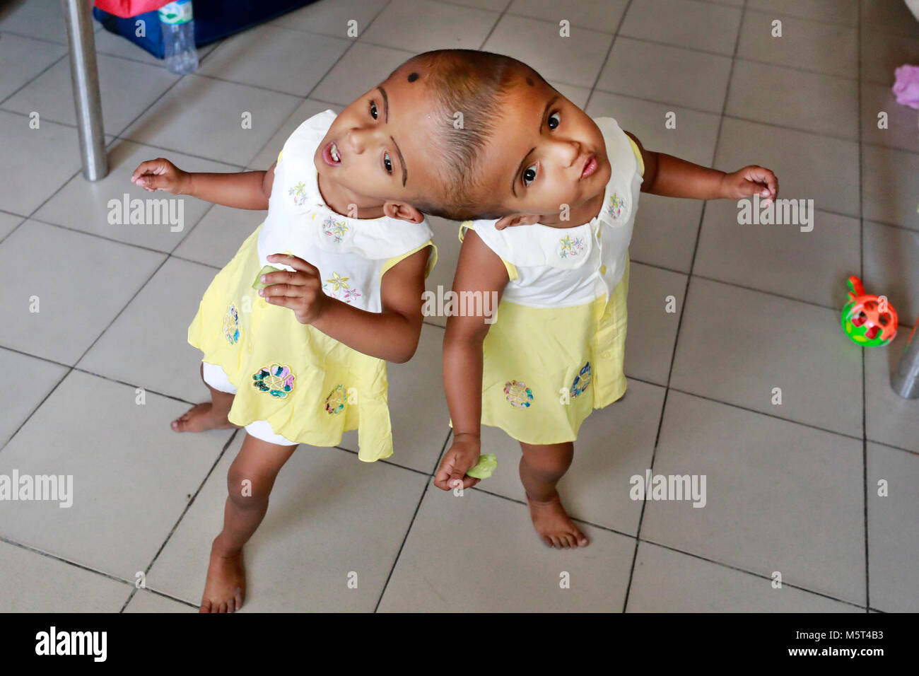 Dhaka, Bangladesh. 26th February, 2018. Conjoined twin girls Rabeya ...