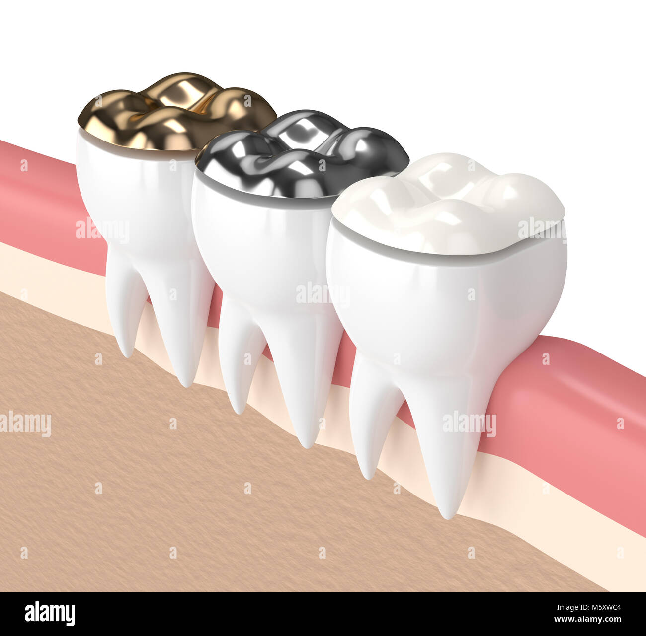 3d render of teeth with gold, amalgam and composite onlay dental ...